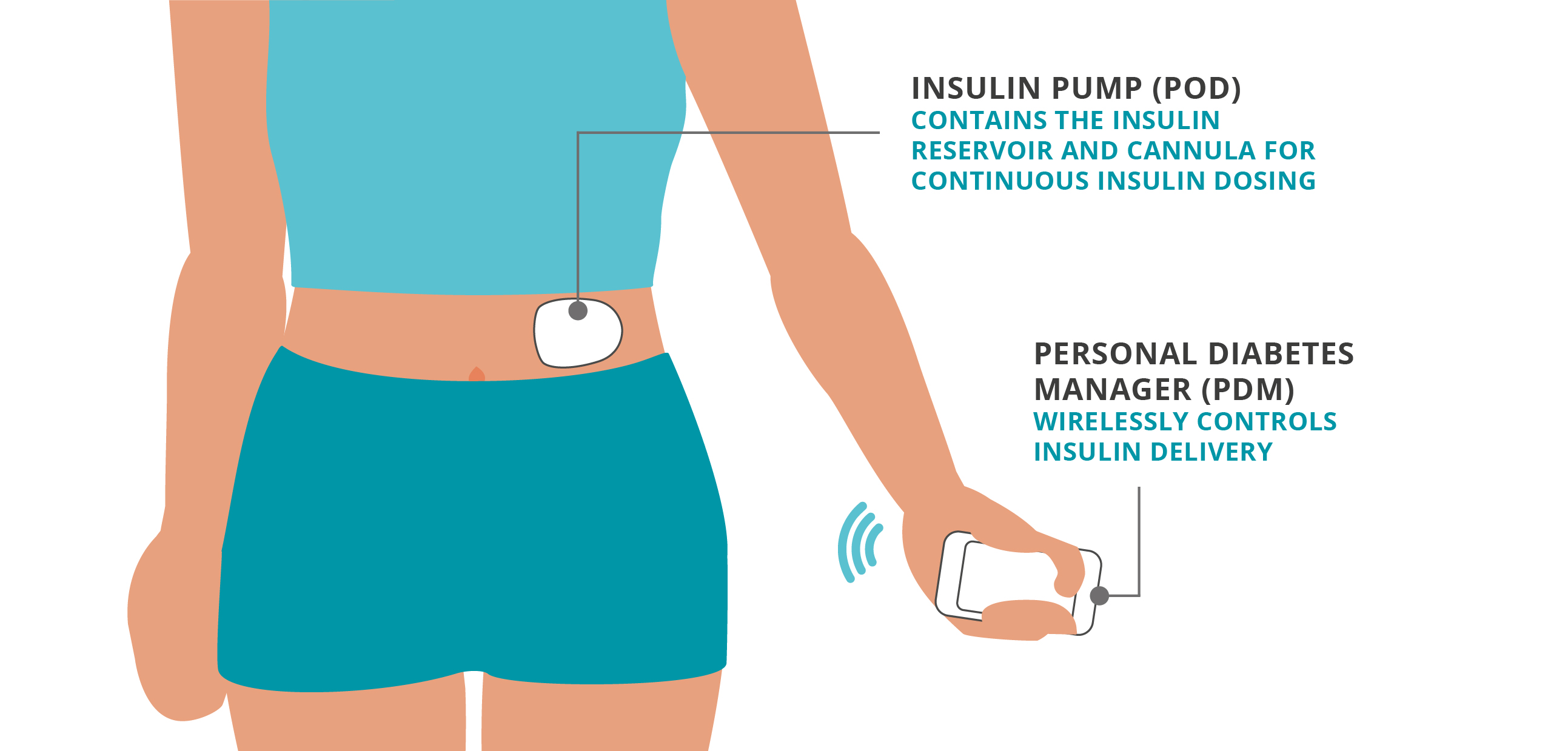 Insulin Pumps Types How They Work Omnipod UK Insulin Pumps Types How They Work Omnipod UK
